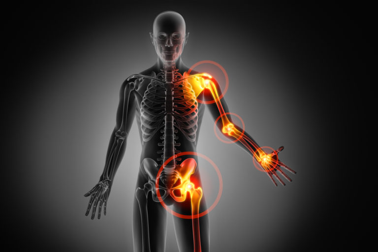 Artrite reumatóide: entenda a doença e seus sintomas – Dr. Bruno Pavei